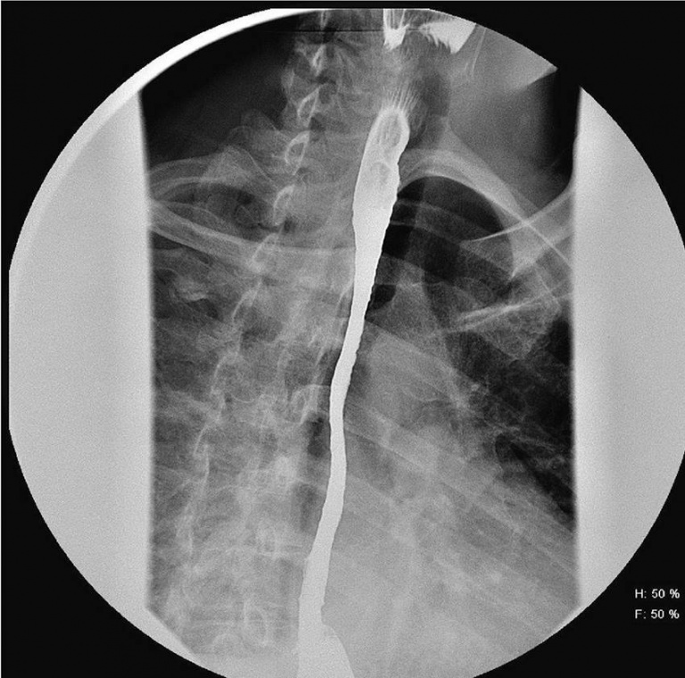 Esofagite Eosinofílica uma atualização: epidemiologia, fisiopatologia ...